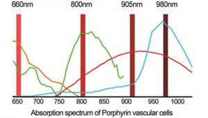 980nm Diode Laser Technology For Vascular Lesions Treatment | PrettyLasers