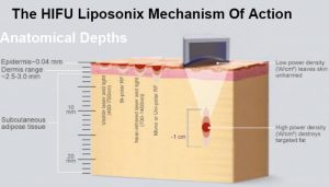 HIFU Technology - Non Surgical Facelift & Skin Tightening Treatment ...