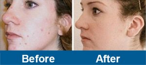 Medical Grade LED Light Therapy For Skin Machine | PrettyLasers