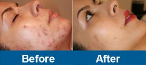 Medical Grade LED Light Therapy For Skin Machine | PrettyLasers