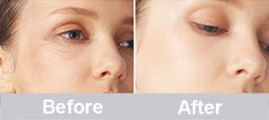 Velashape Machine - For Cellulite & Body Contouring | PrettyLasers