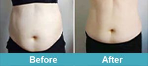 Infrared Pressotherapy Lymphatic Drainage Massage | PrettyLasers